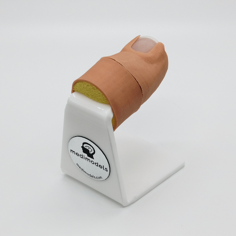 Onychocryptosis | Ingrown toenail model | Medimodels